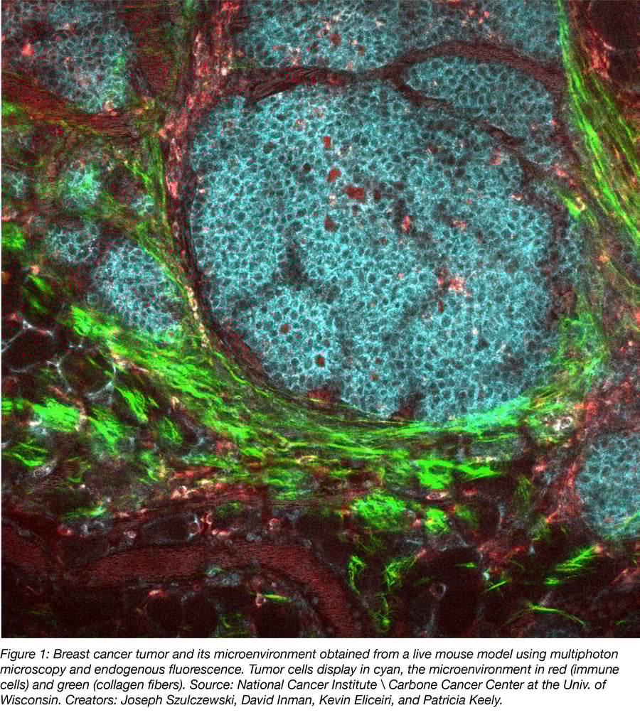 The Breast Cancer Microenvironment: A Tumor’s Backstage Team